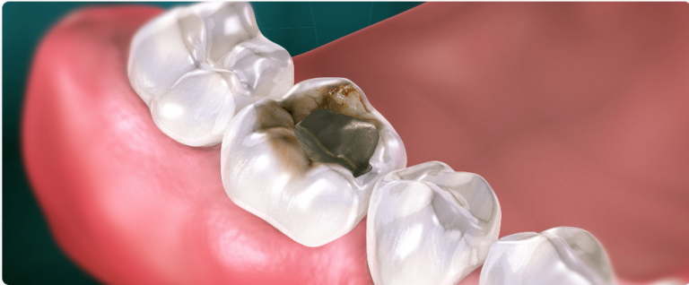 Types of Tooth Decay - Skulman